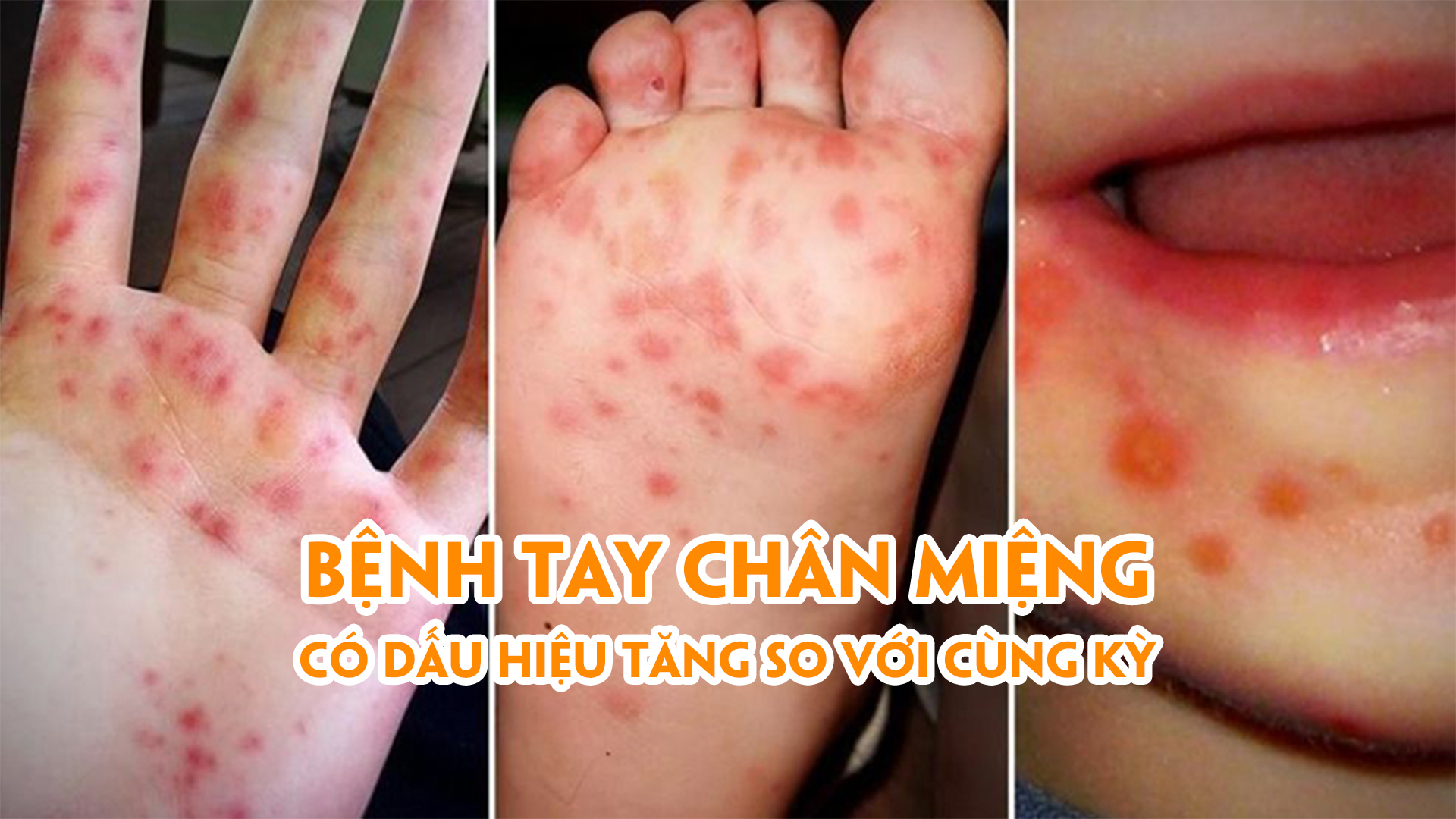 Bệnh tay chân miệng có dấu hiệu tăng ở Hậu Giang - Truyền Hình Hậu Giang